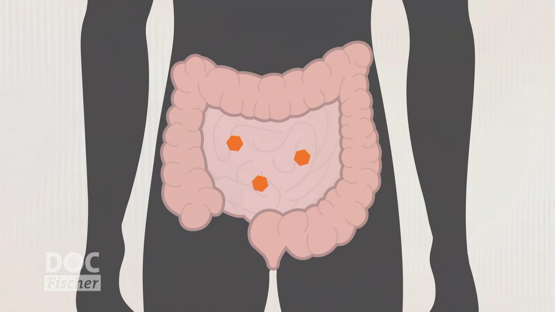 Doc Fischer: Reizdarm - die richtige Diagnose und Behandlung | ARD ...